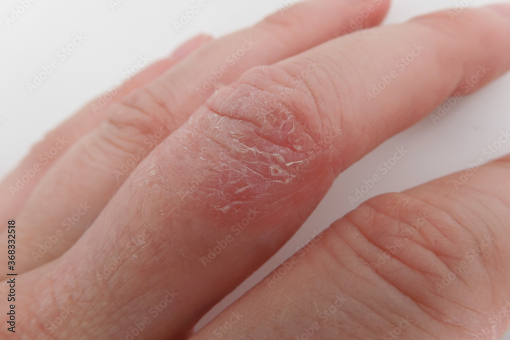 Finger skin disease (dermatitis, eczema) Stock Photo | Adobe Stock