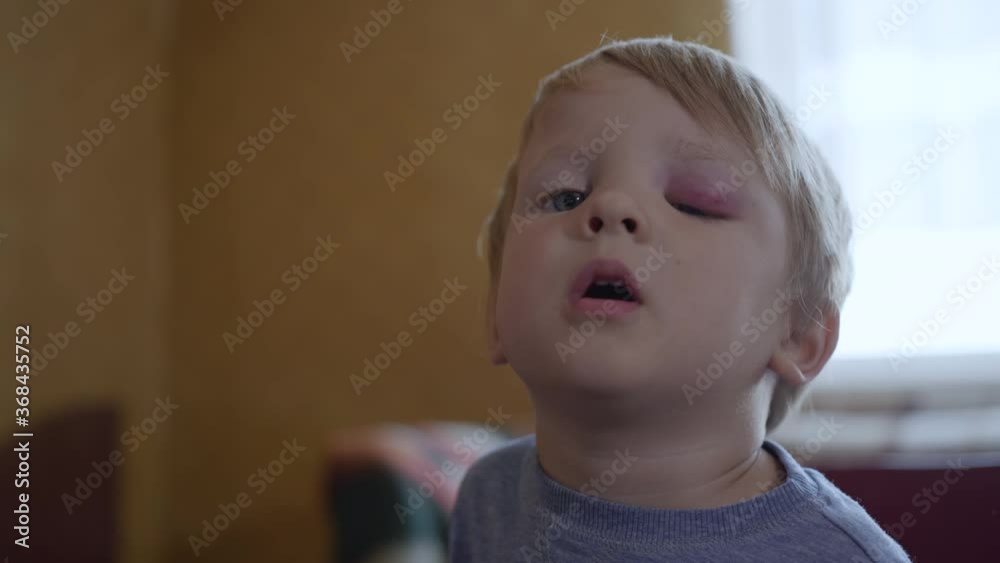 small male child with an injury or a bruise on his face cannot open his ...