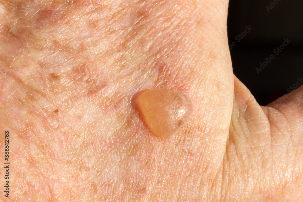 Raised blister caused by cryotherapy to remove solar keratosis lesion ...