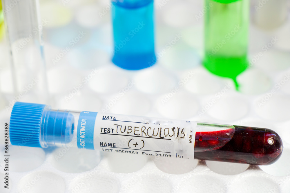 Tuberculosis blood test tube, laboratory and chemical instruments ...