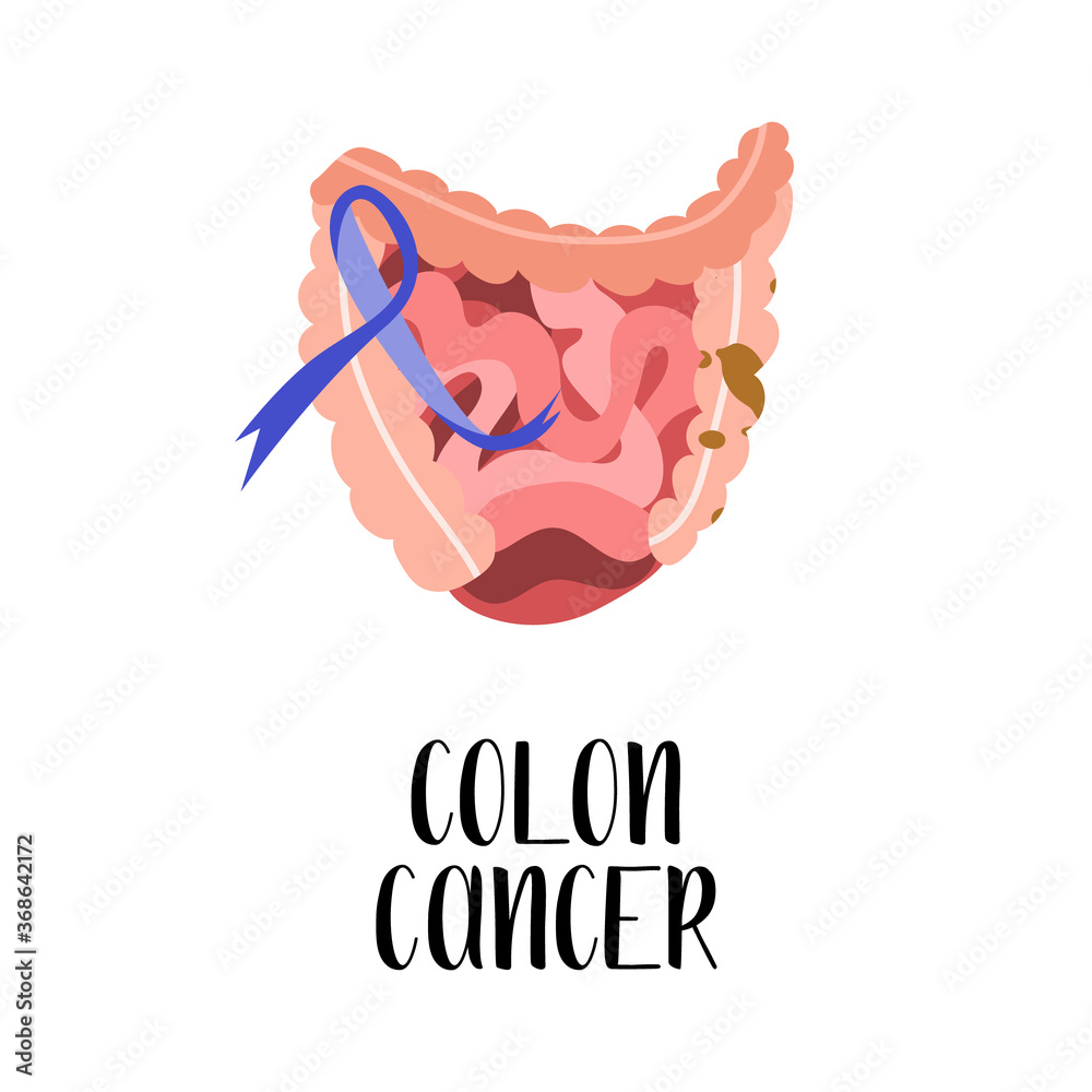 Colon cancer, carcinoma. Dark blue awareness ribbon. Oncology ...
