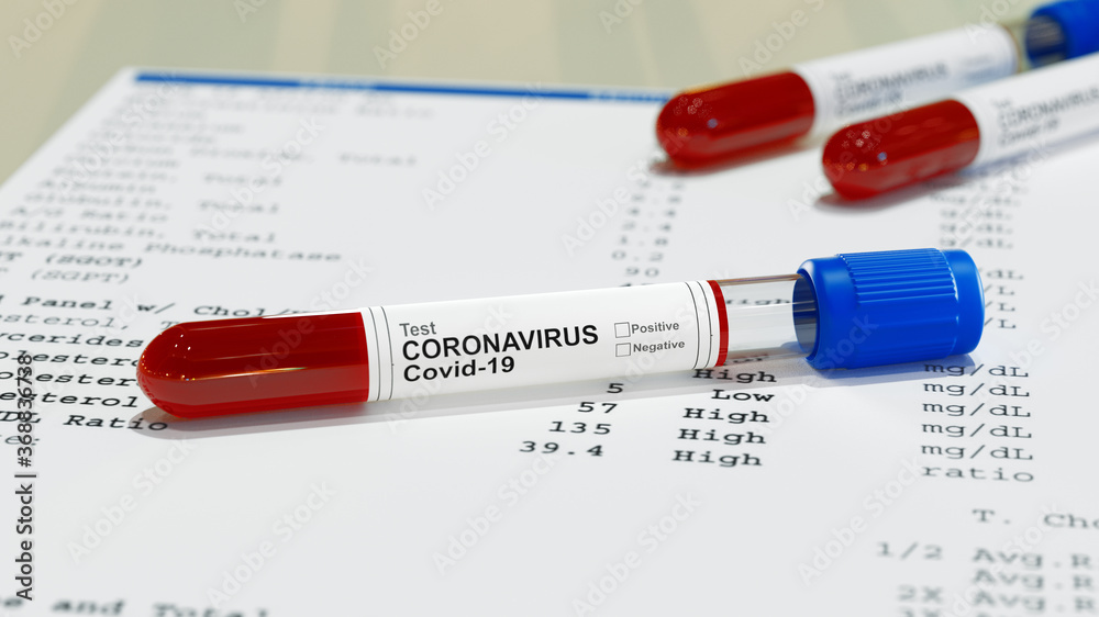 Negative or positive test result by using rapid test device for COVID ...