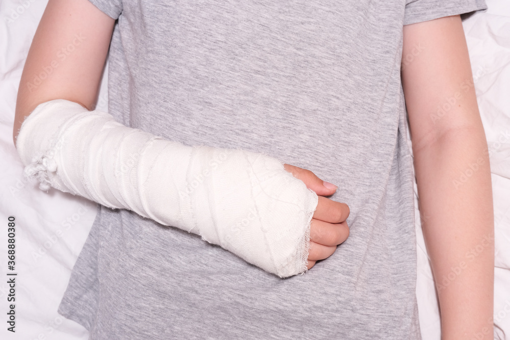 A child broken arm in plaster case, hand injury because of accident ...