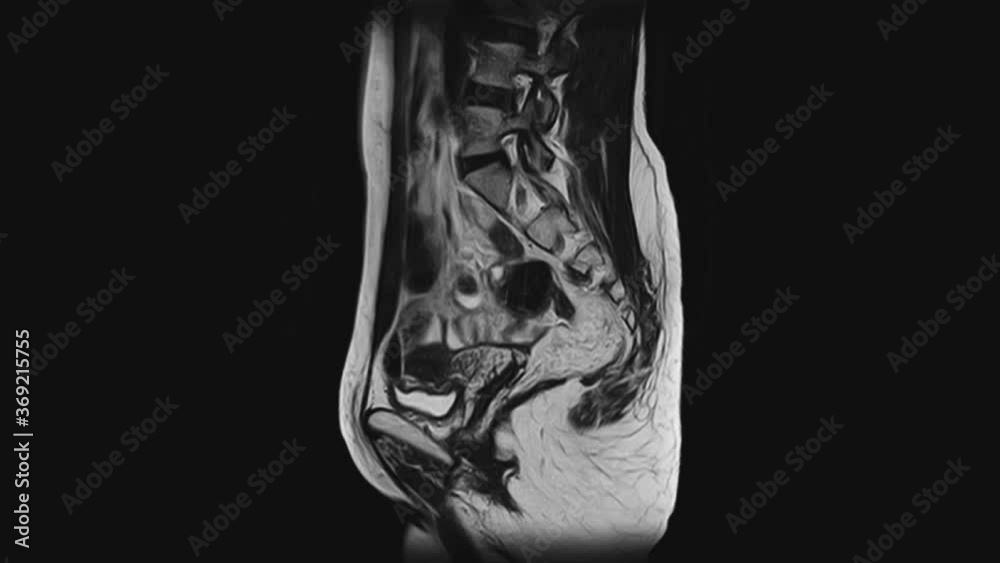 MRI of the female pelvic organs, abdominal cavity, gastrointestinal ...