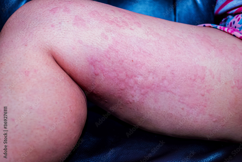 Skin disease on the body, viral skin disease Measles rash with ...