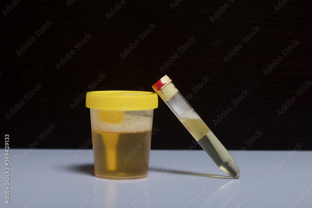 Urine in test container and vacuum tube. Disposable medical polymeric ...
