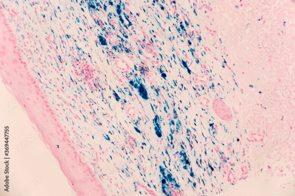 Skin with heavy iron deposits, called hemosiderin, which appear blue in ...