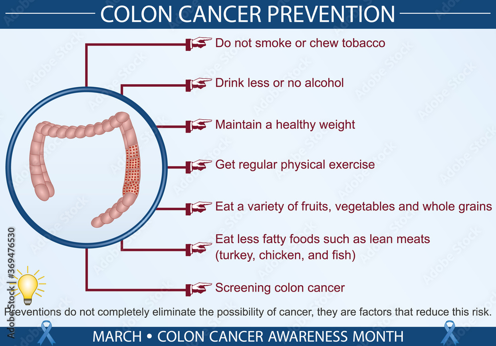 Colon cancer prevention infographic vector. March colon cancer ...