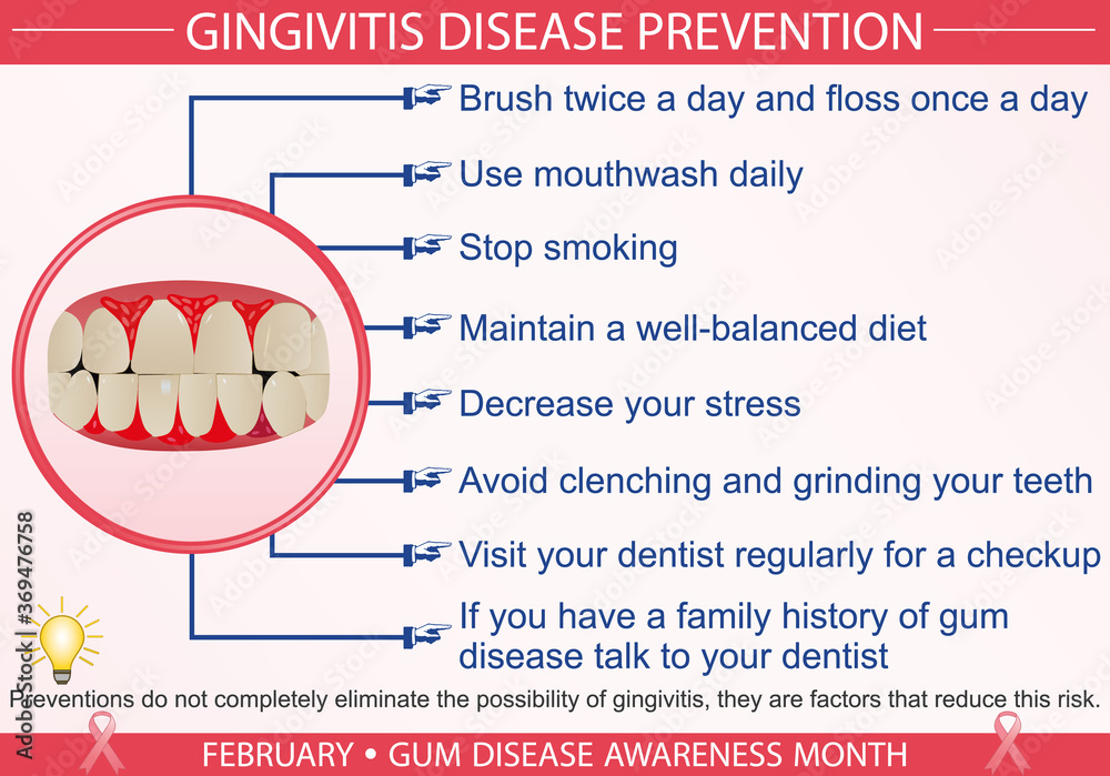 Gingivitis disease prevention infographic vector. February gum disease ...