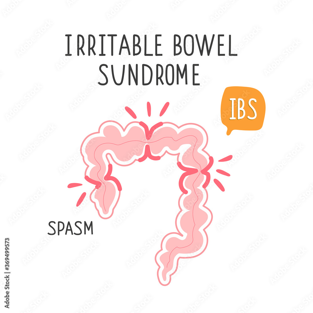 Irritable bowel syndrome. Illustration of a spasm on the gut. Vector ...