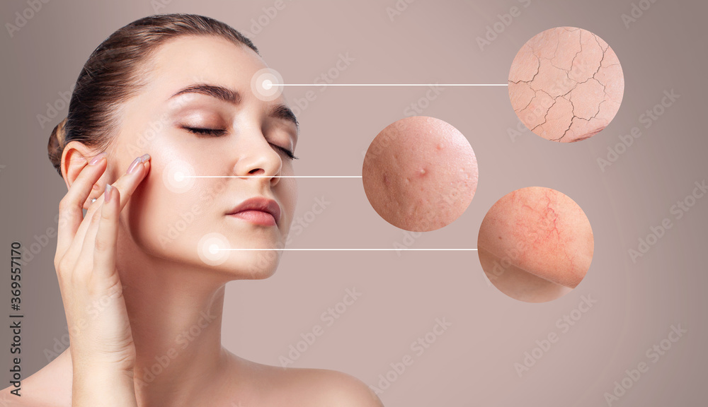 Magnifying circles shows skin problems - couperose and acne on skin of ...