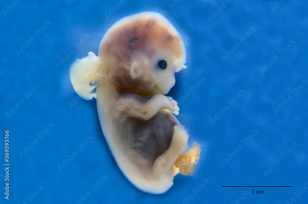 Human embryo with occipital encephalocele. Stock Photo | Adobe Stock