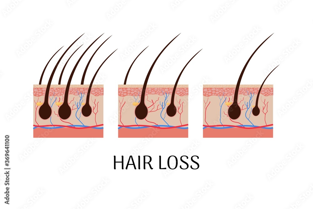 Anatomical concept hair loss stages, infographic isolated on white ...