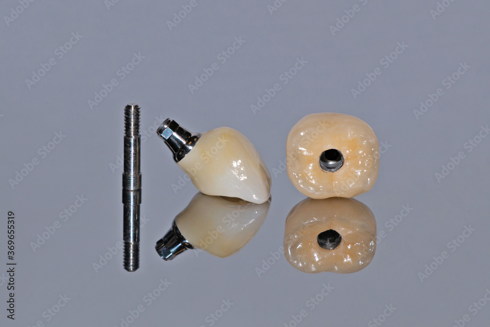 Incisor and molar crowns for implant fixation. Screw fixation of the ...