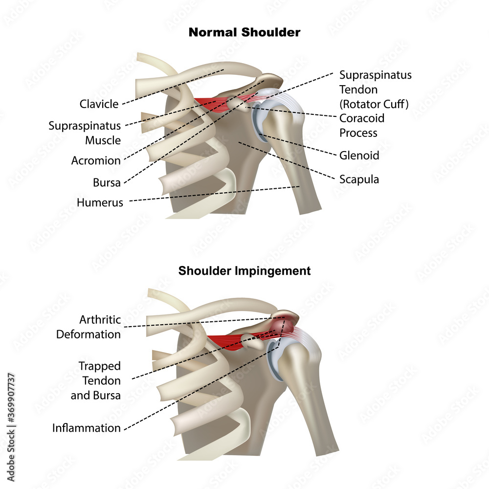 shoulder impingement, , medical posters with symbols, vector ...