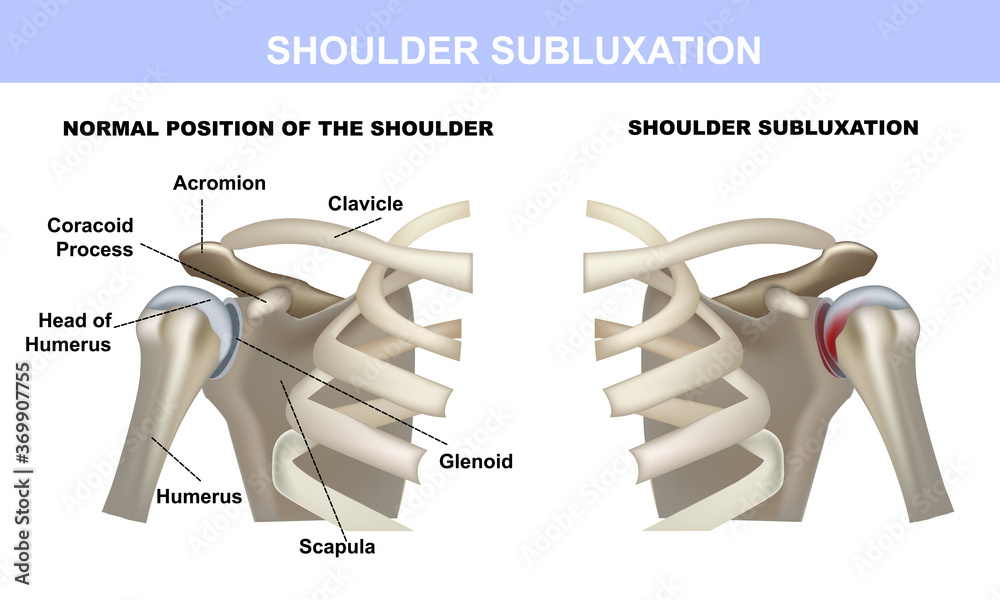 shoulder subluxation, healthy shoulder joint and shoulder joint with ...