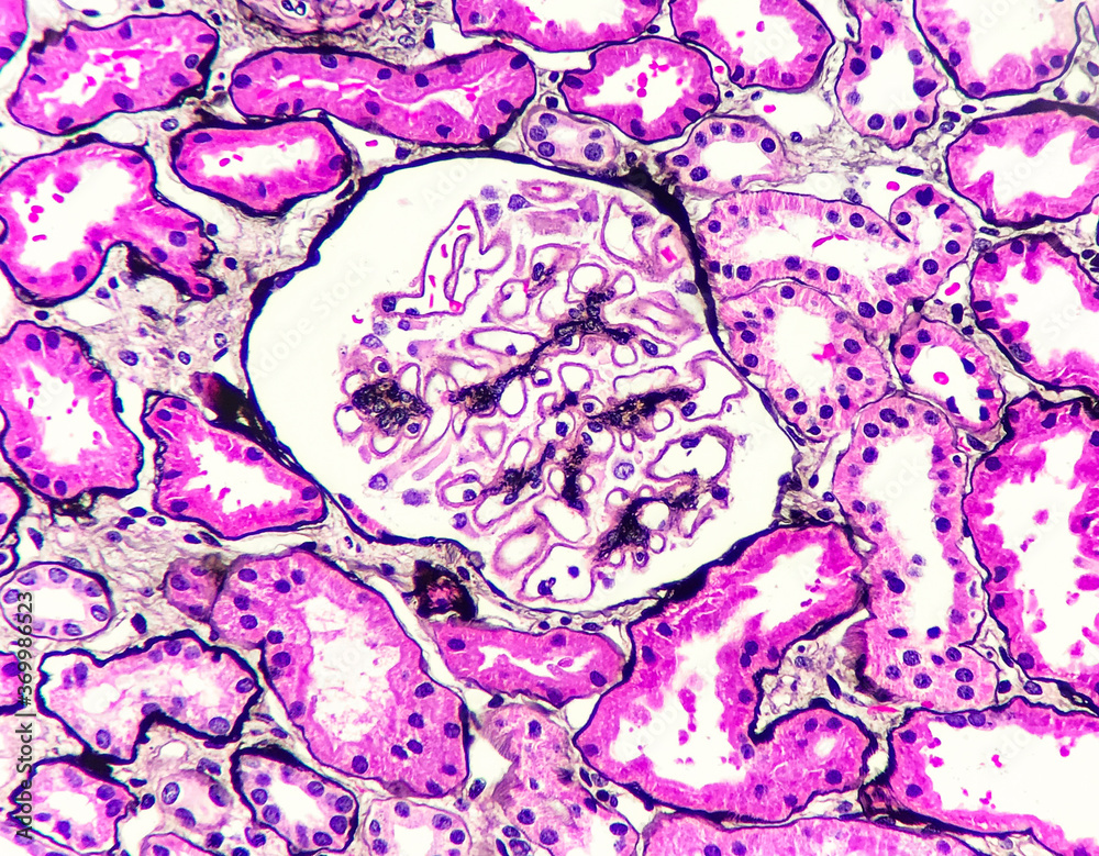 Membranous Glomerulonephritis Silver Stain
