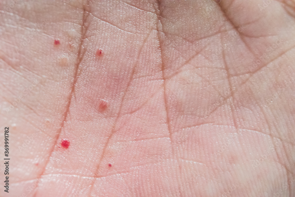 Atopic dermatitis (AD) on the hand, also known as atopic eczema or ...