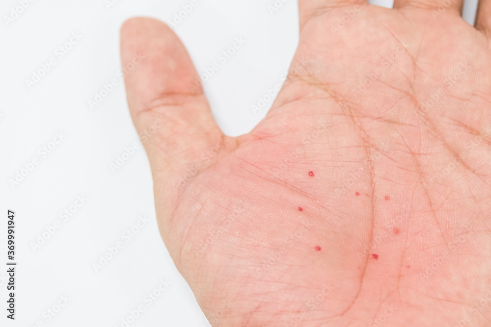 Atopic dermatitis (AD) on the hand, also known as atopic eczema or ...