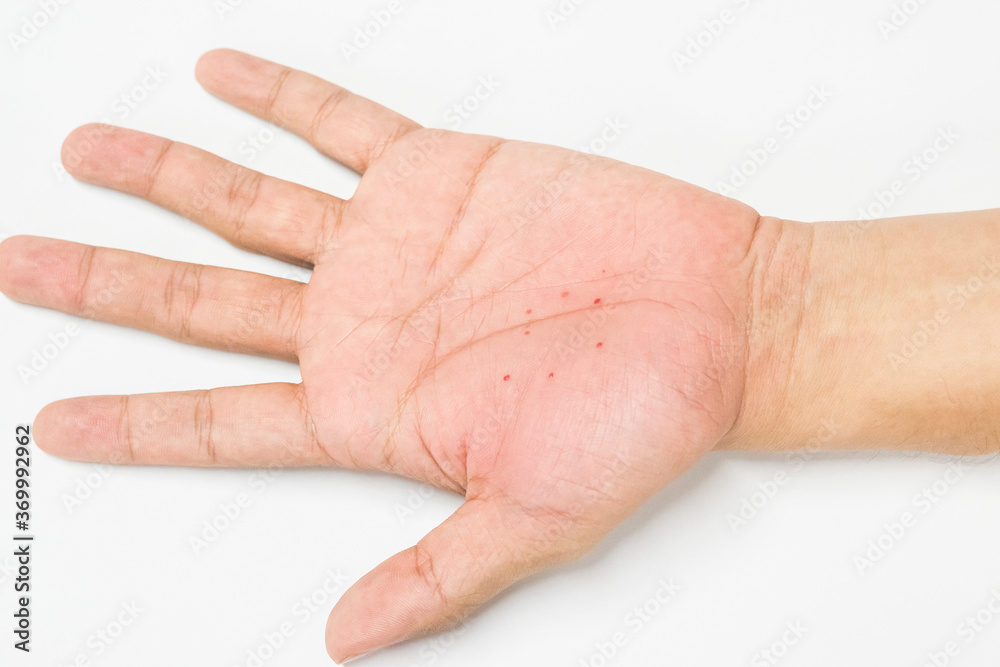 Atopic dermatitis (AD) on the hand, also known as atopic eczema or ...