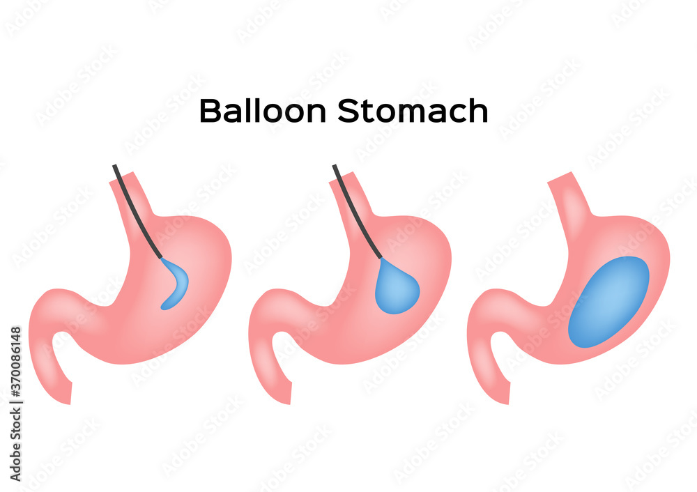balloon stomach vector . human anatomy Stock Vector | Adobe Stock