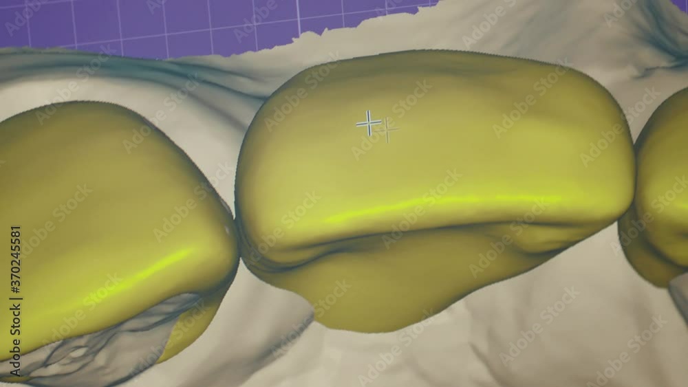 3D modeling teeth showing on computer dental implant equipment medical ...