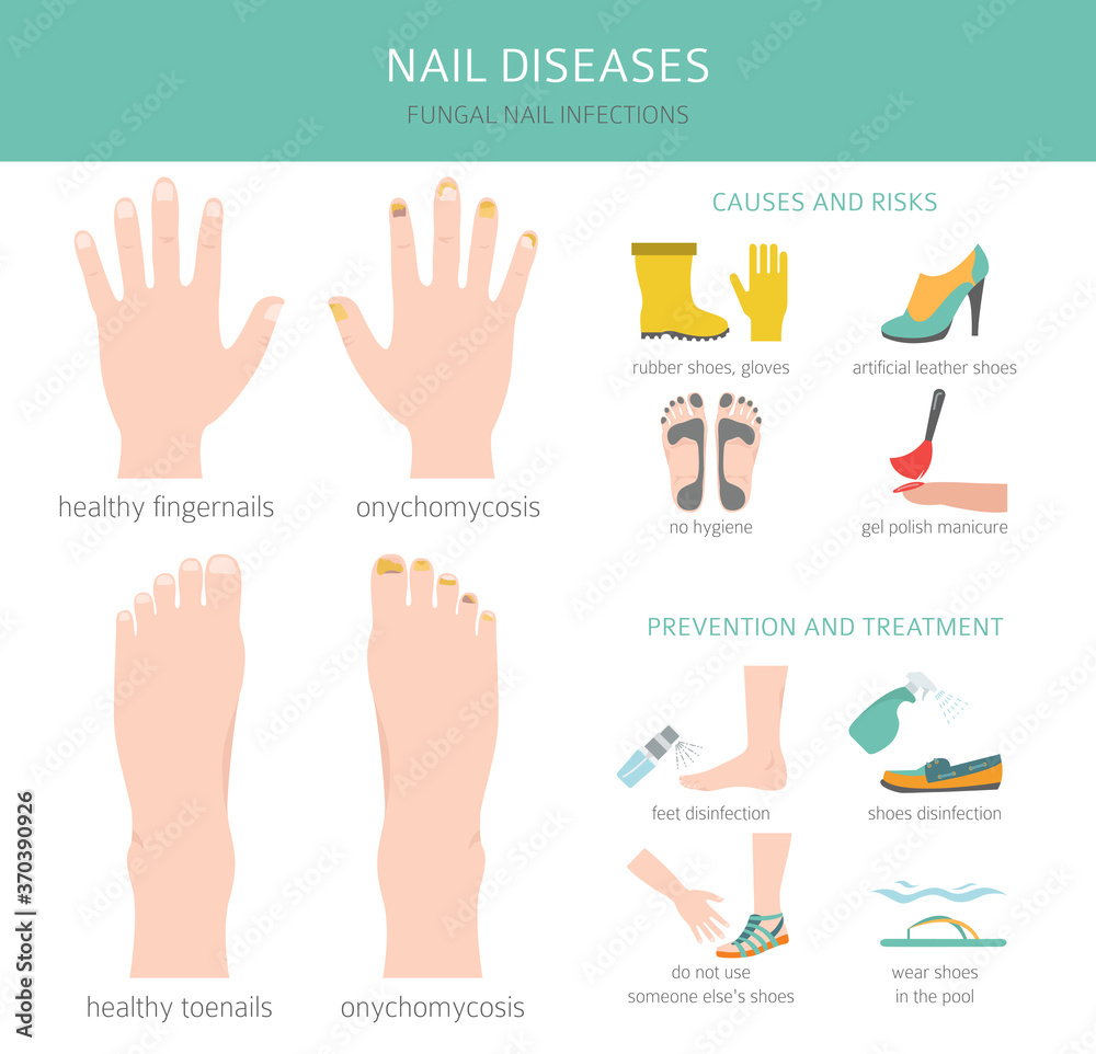 Nail diseases. Onychomycosis, nail fungal infection causes, treatment ...