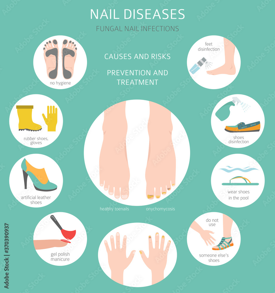 Nail diseases. Onychomycosis, nail fungal infection causes, treatment ...