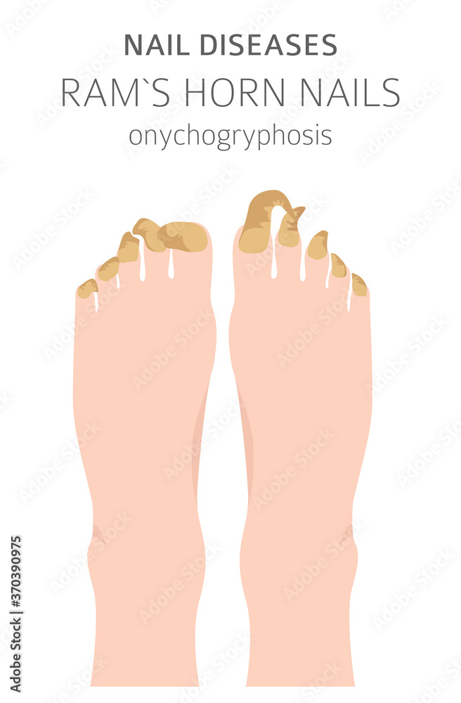 Nail diseases. Onychogryphosis, Ram`s horn nail. Medical infographic ...