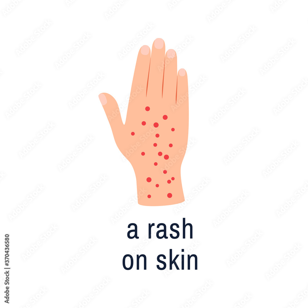 Skin rash icon isolated on white background. Color flat hand palm with ...