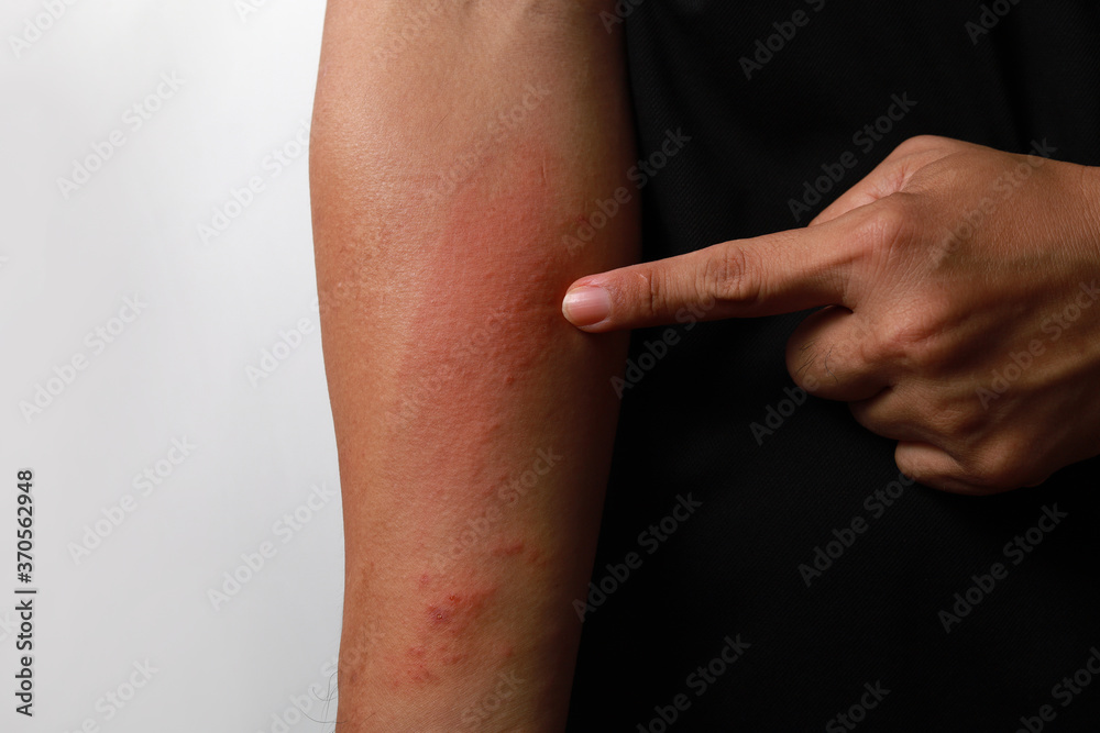 Close up dermatitis on the skin, ill allergic rash dermatitis eczema ...