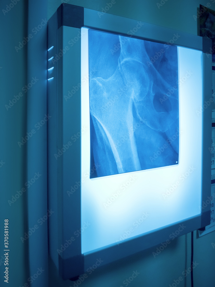 Glowing negatoscope with x-ray of femur fracture and pelvic bones Stock ...