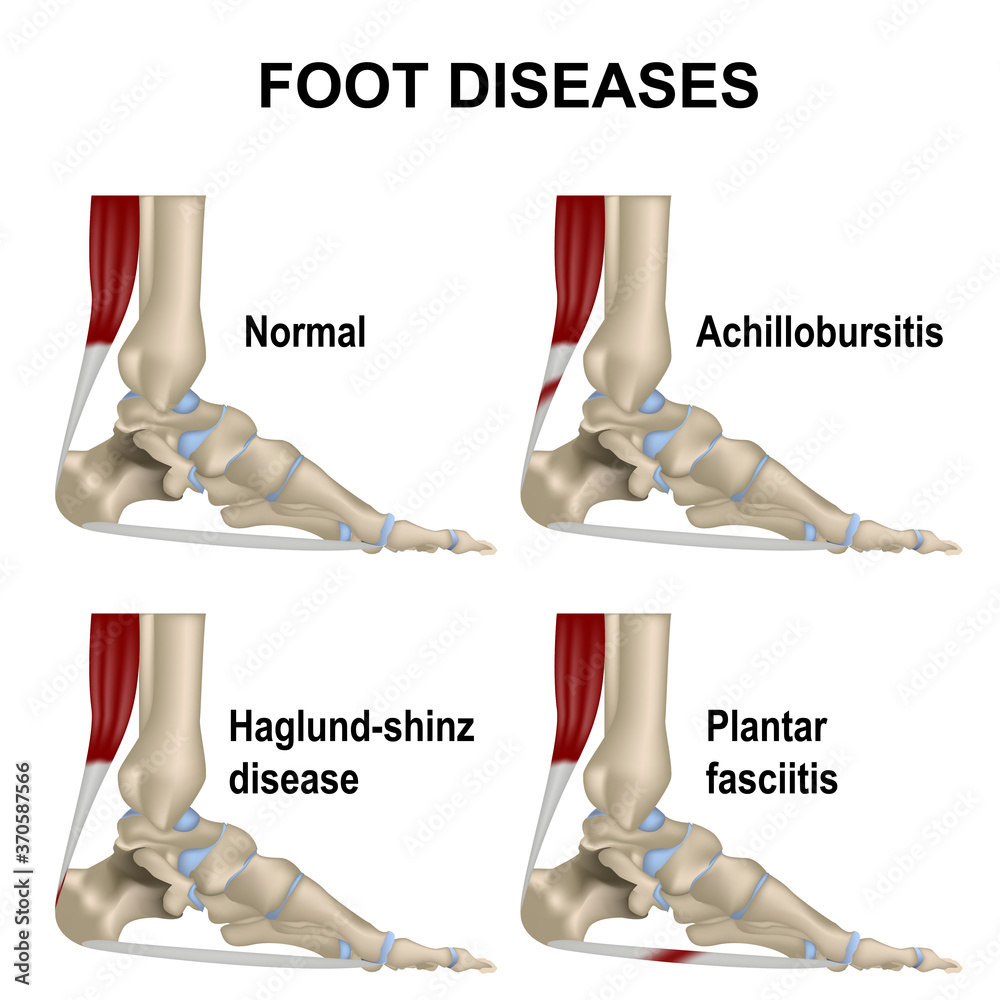 Foot joint, normal foot and diseases. Plantar fasciitis ...