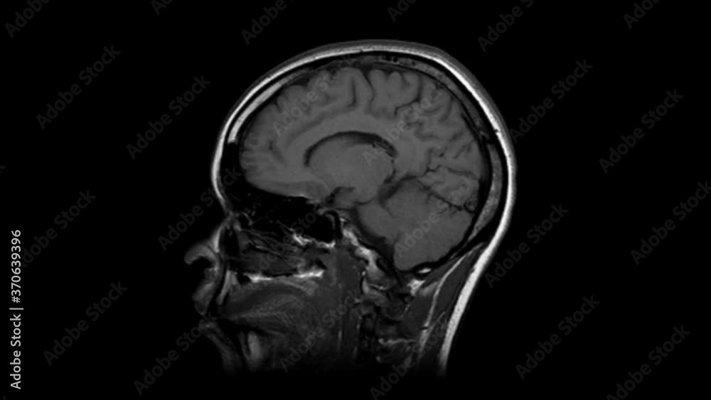 Time lapse of MRI brain scan, timelapse of monochrome magnetic ...