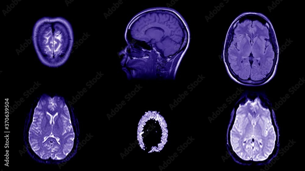 Time lapse of MRI brain scan set, timelapse magnetic resonance imaging ...