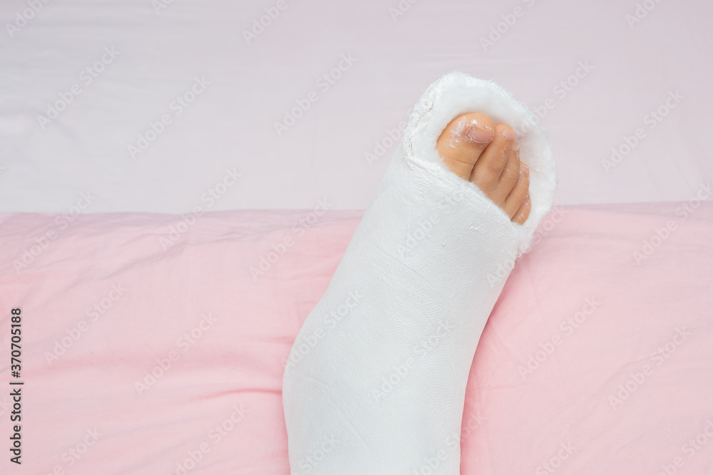 Leg in plaster of a teenage girl on a pink bed after an accidental fall ...