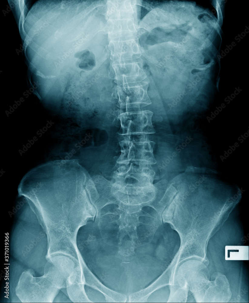 x-ray image of human spine Stock Photo | Adobe Stock