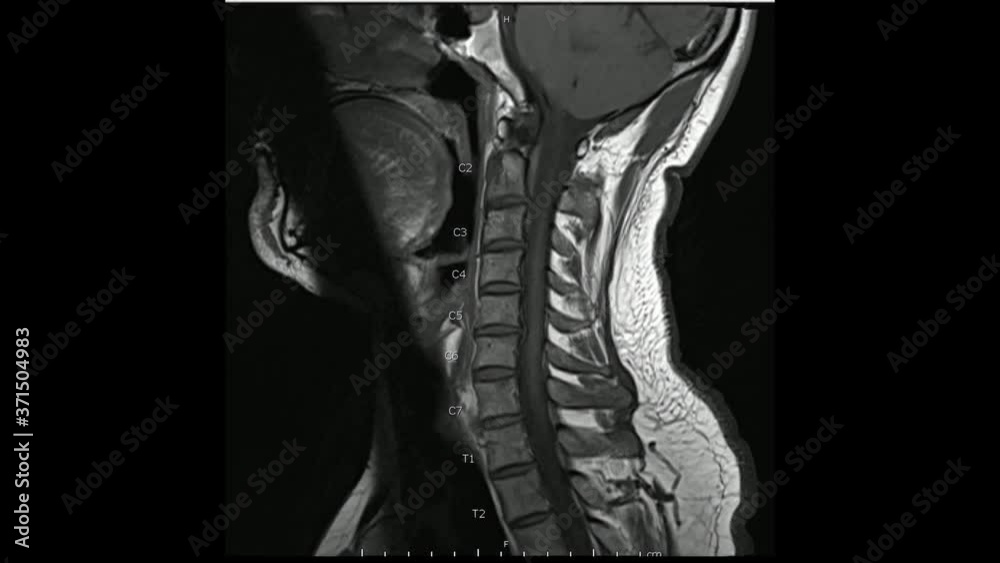 Magnetic Resonance images of Cervical spine sagittal T1-weighted images ...