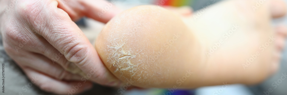 Foto de Close-up of badly cracked heel. Persons feet with dry skin ...