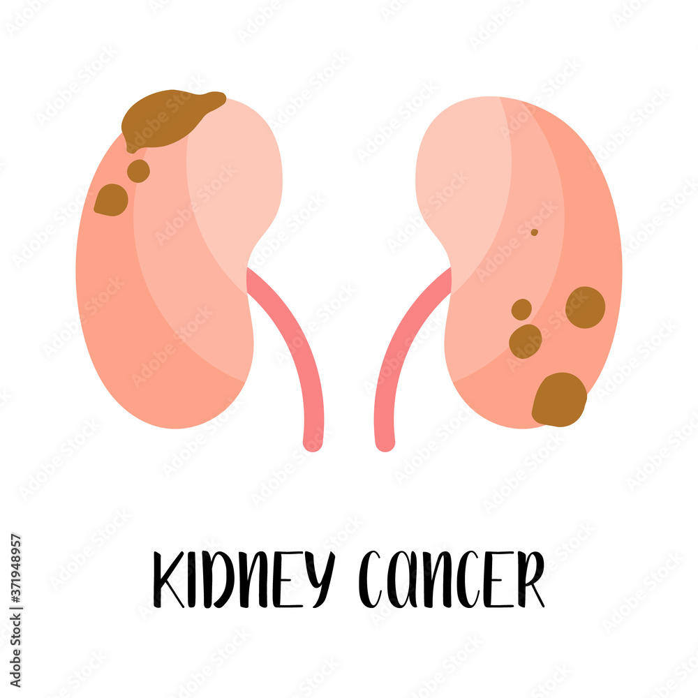 Kidney cancer, carcinoma. Oncology. Vector flat illustration, isolated ...