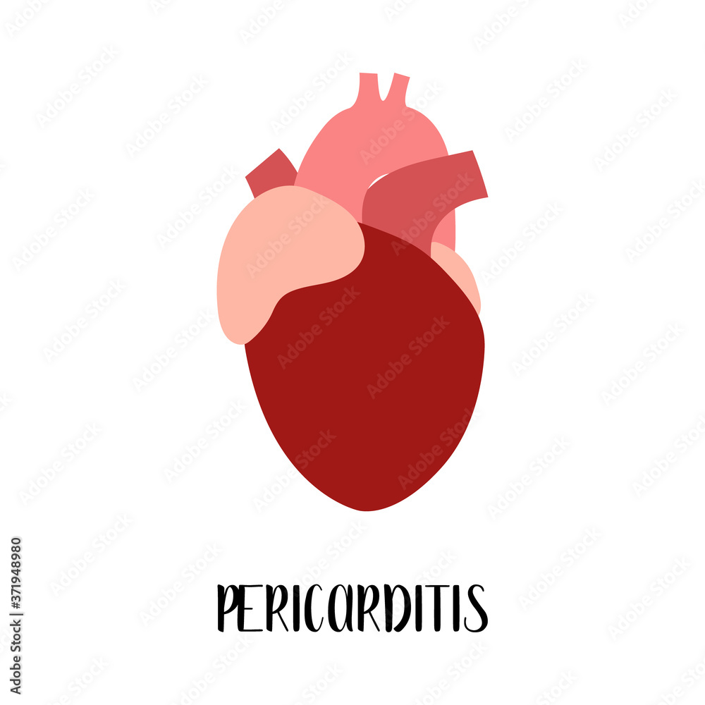 Pericarditis. Heart, cardiovascular diseases. Cardiology. Vector flat ...