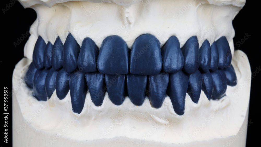 wax up of blue wax of the upper and lower jaws. models in bite on a ...