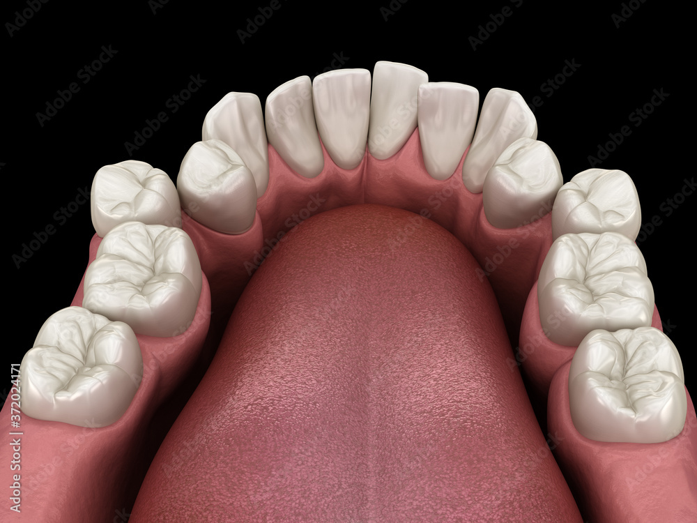 Abnormal teeth position, orthodontic concept. Medically accurate tooth ...