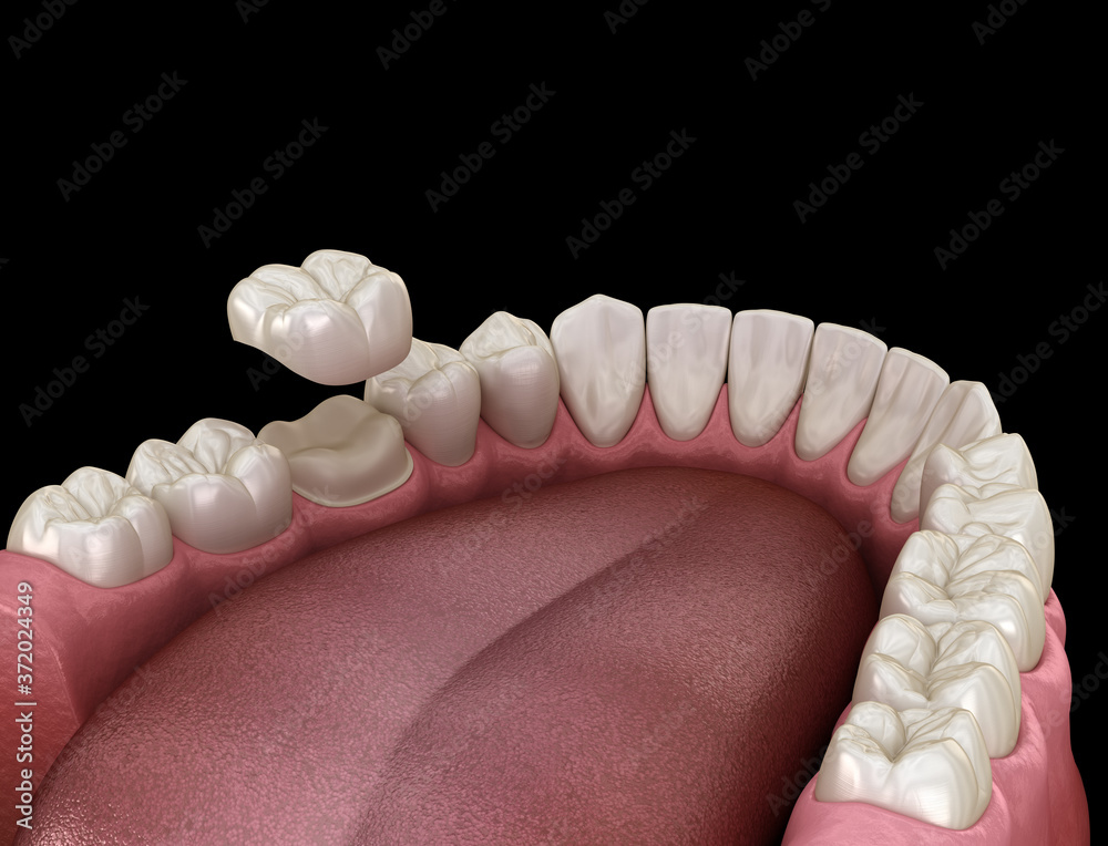 Preparated molar tooth for dental crown placement. Medically accurate ...