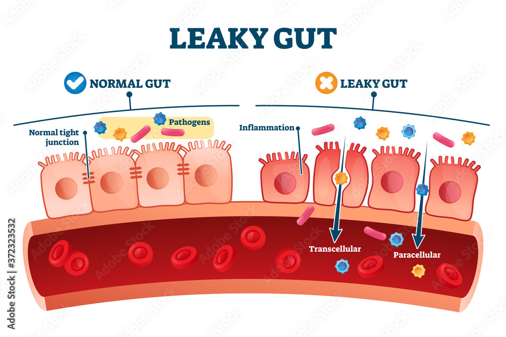 Póster Leaky gut syndrome as medical chronic inflammation condition explanation – Cuadro para ...