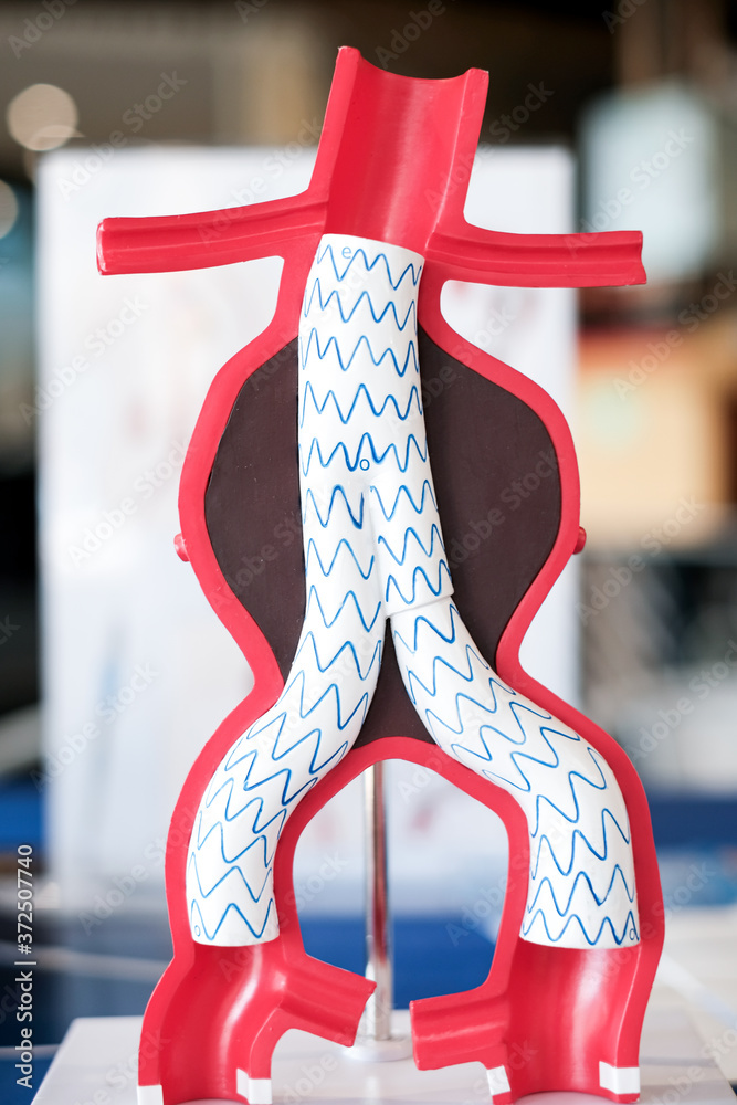 focus at a model of endovascular aneurysm repair (evar) for people ...