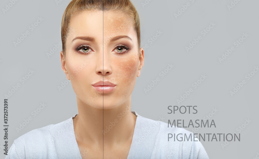 Foto de Dark spots, freckles,hyperpigmentation(melasma or chloasma ...