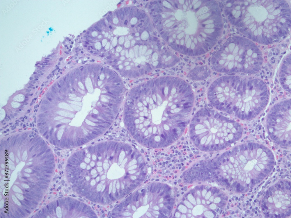 Tubular Adenoma - benign polyp of the colon but precusor to cancer 20x ...