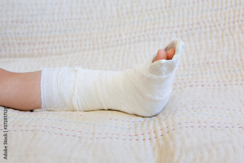 broken leg. Close-up of the cast on the feet. exercises to repair and ...