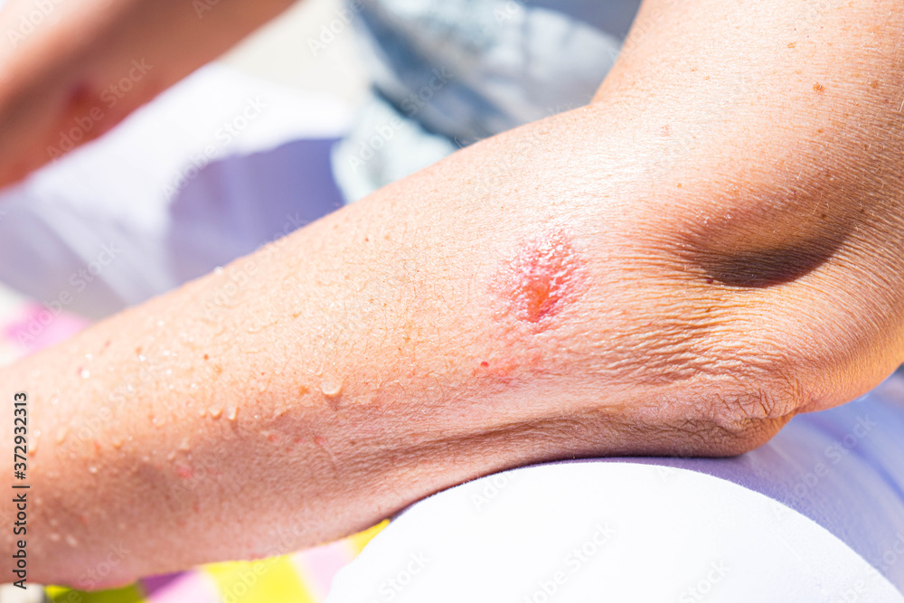 Swollen and infected red spot on woman's arm from a poison ivy rash and ...